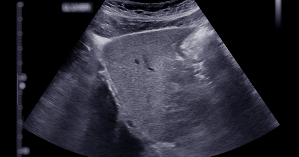 Liver Elastography: Ultrasound and MRI from $152.42 (2025)